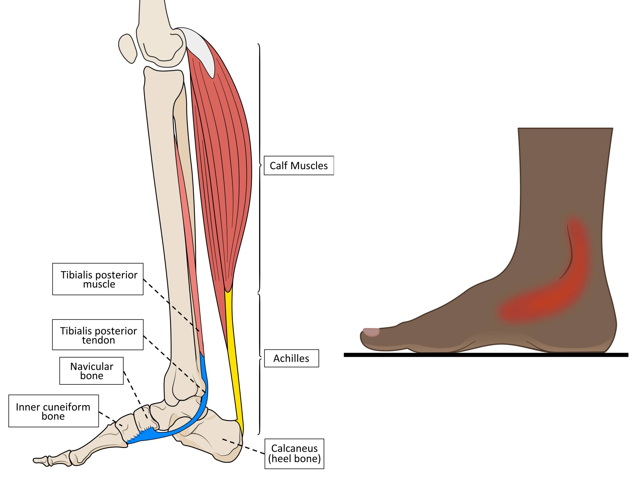 Tibialis Posterior Dysfunction (TPD) is a Pain in the ‘Ankle’ and ‘Arch ...