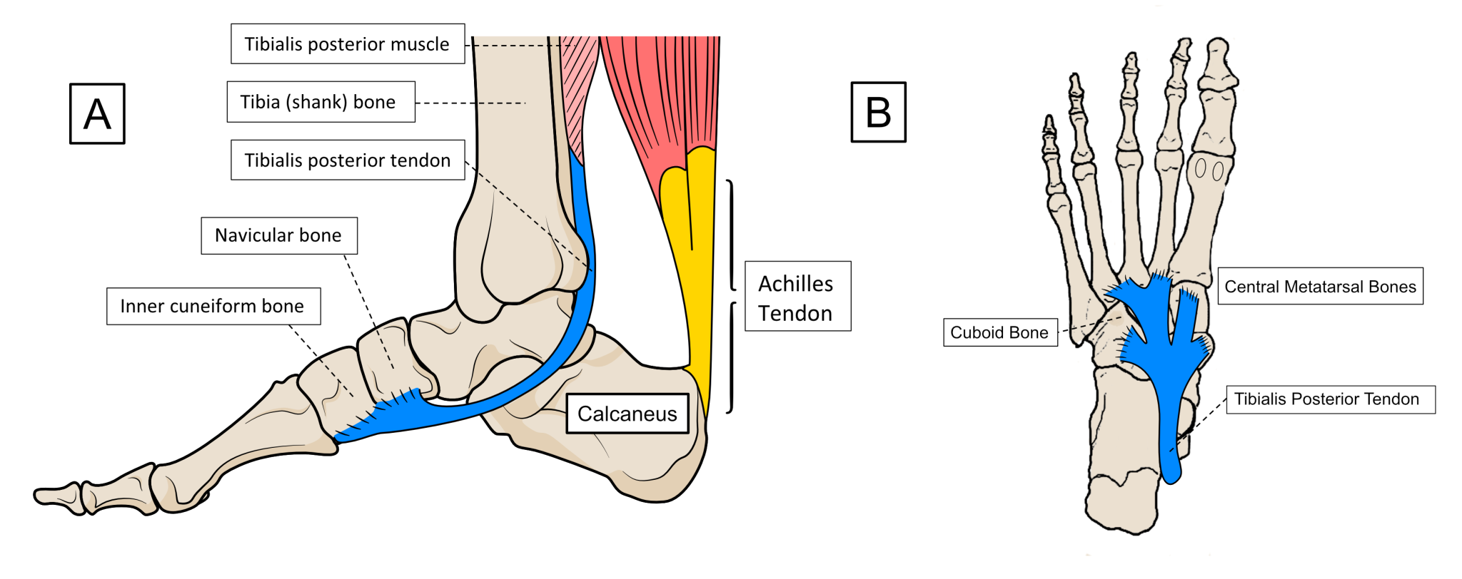 Tibialis Posterior Dysfunction (TPD) is a Pain in the ‘Ankle’ and ‘Arch ...