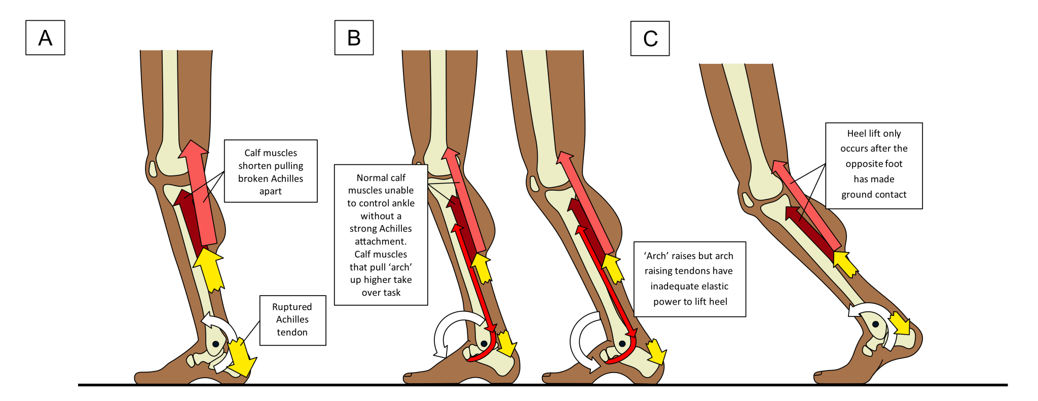 Achilles Tendinitis/Tendinopathy: The pain behind the ankle/heel! - Insoles and Orthotics ...