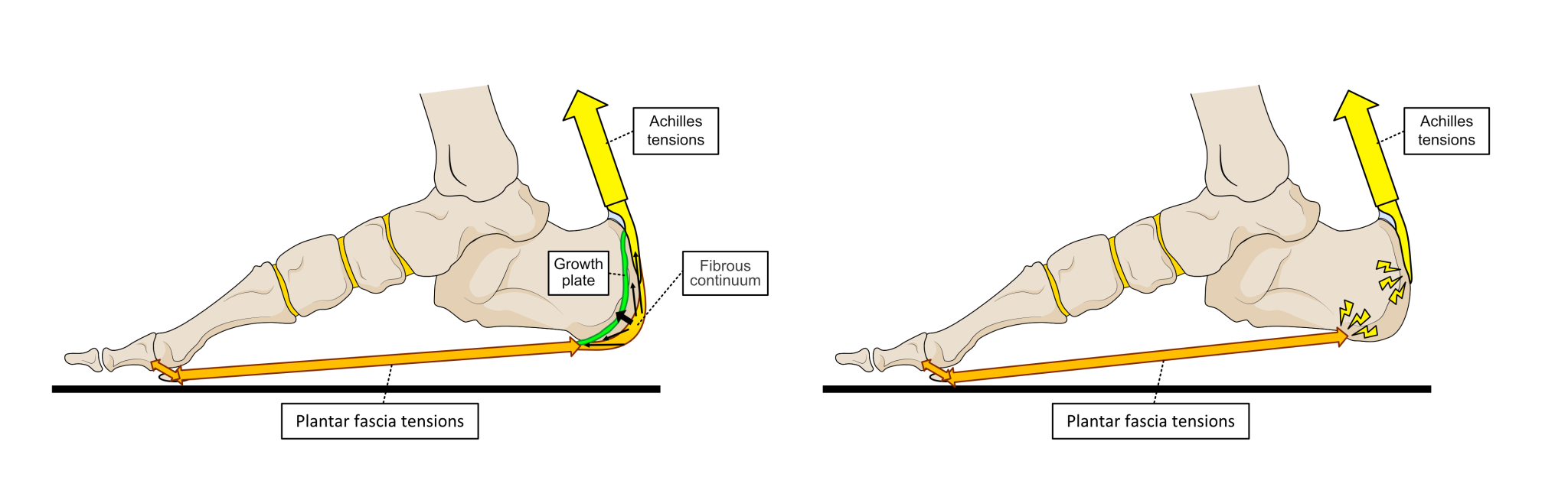 Achilles Tendinitis/Tendinopathy: The pain behind the ankle/heel ...